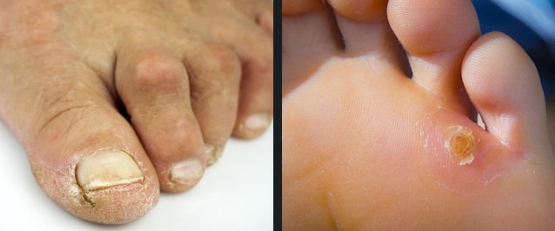 Expert Insights: Understanding and Treating Common Foot Disorders