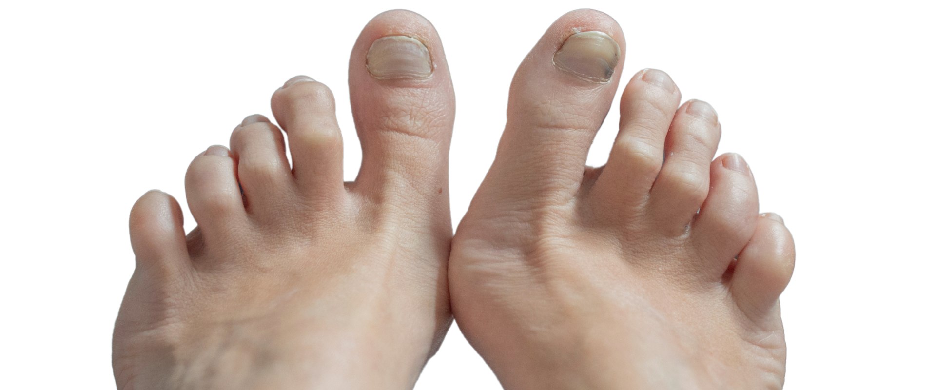 What’s Behind Curled Toes? Causes of Claw Toe Deformity You Should Know